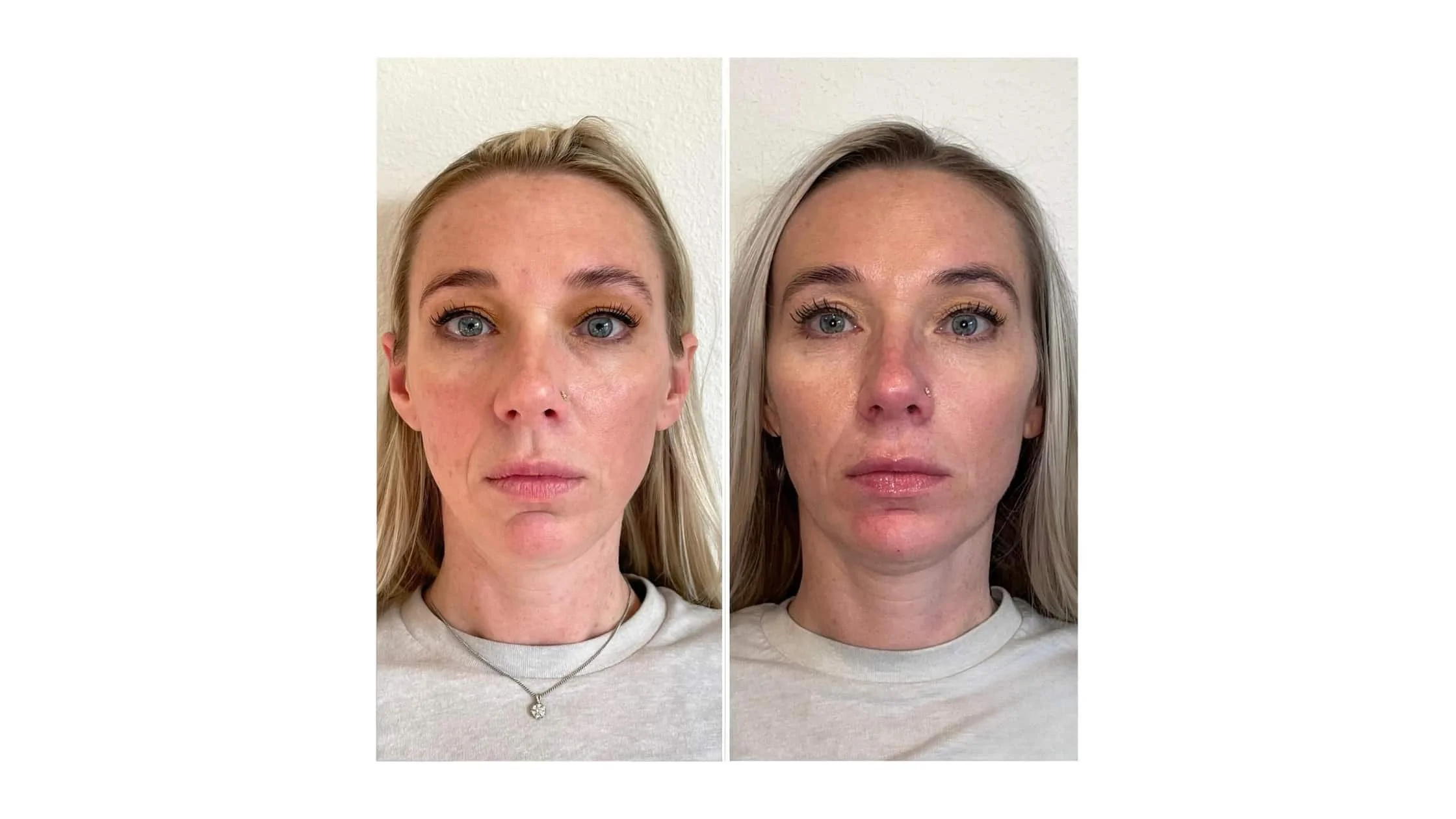Everything You Need to Know About Facial Balancing — Maui MedSpa