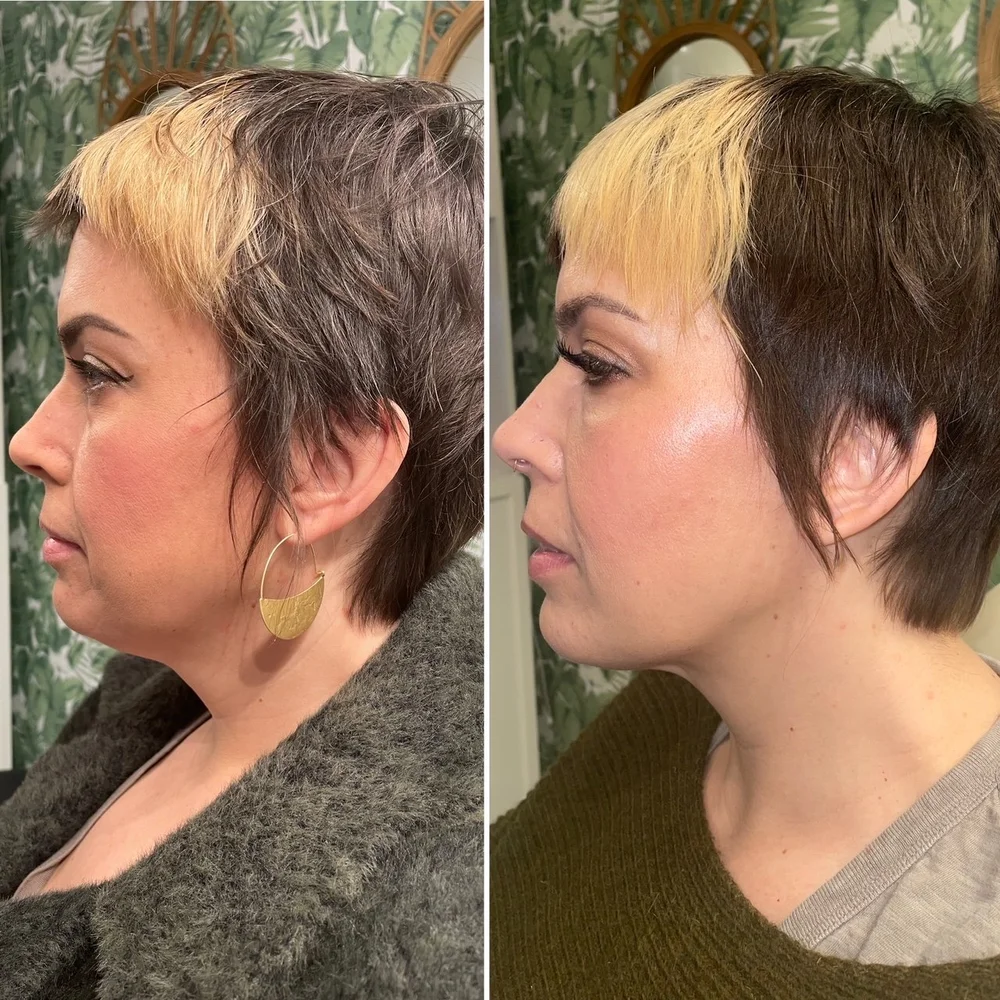 Double Chin No More: How Kybella and Lipodissolve Can Change Your ...