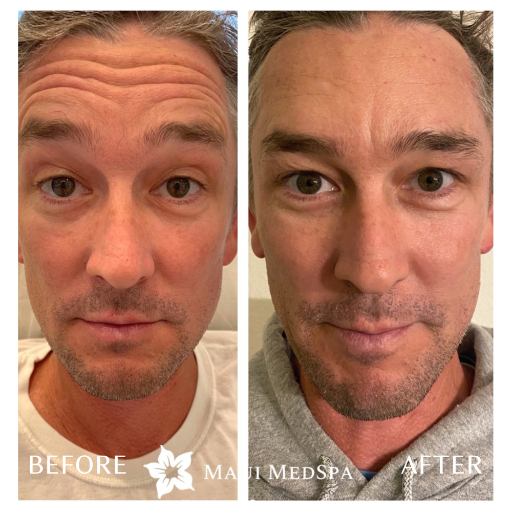 Botox Injections in Austin, TX | $11/unit | Maui MedSpa