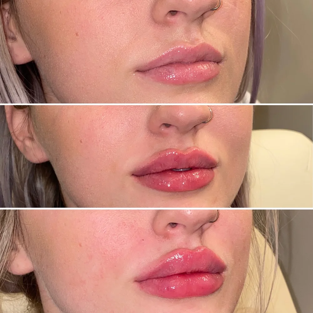 Lip Filler Migration Deep Dive: What It Is & What To Do — Maui MedSpa