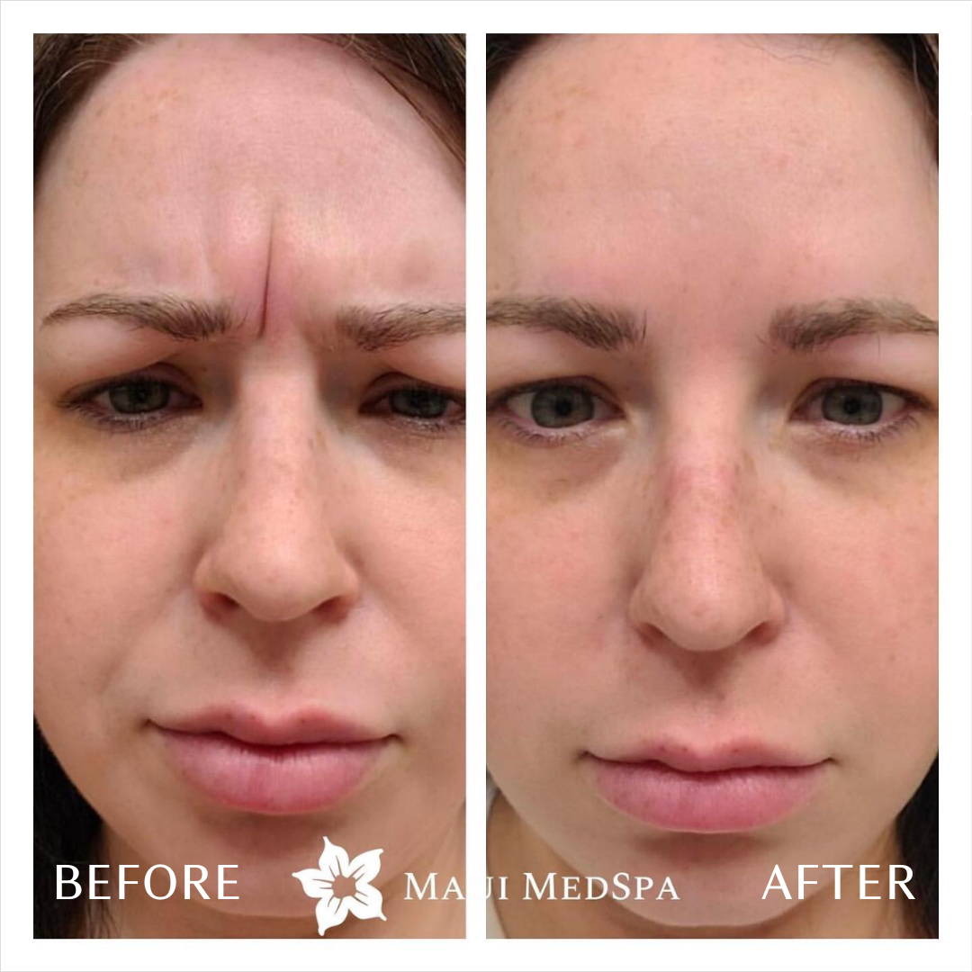 Botox Injections in Austin, TX | $11/unit | Maui MedSpa