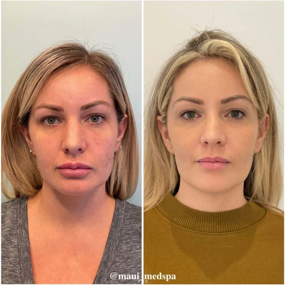 Facial Balancing in Austin, TX - Facial Contouring | Maui MedSpa