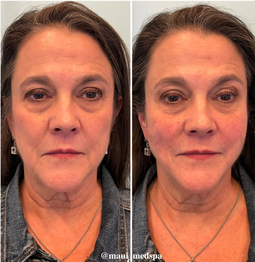 Best PDO Thread Lifts in Austin, TX | Maui MedSpa