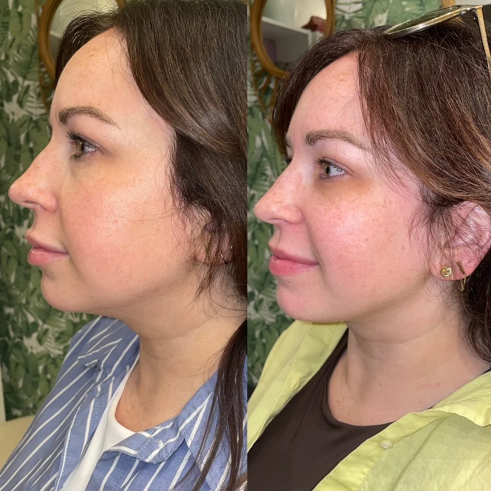 Double Chin No More: How Kybella and Lipodissolve Can Change Your ...