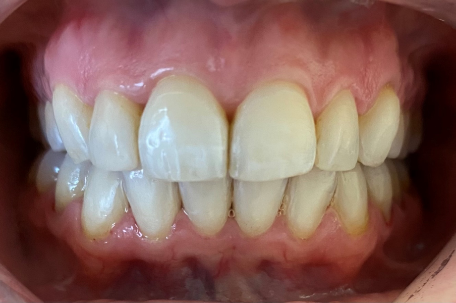 Invisalign — Stormont Dental Care