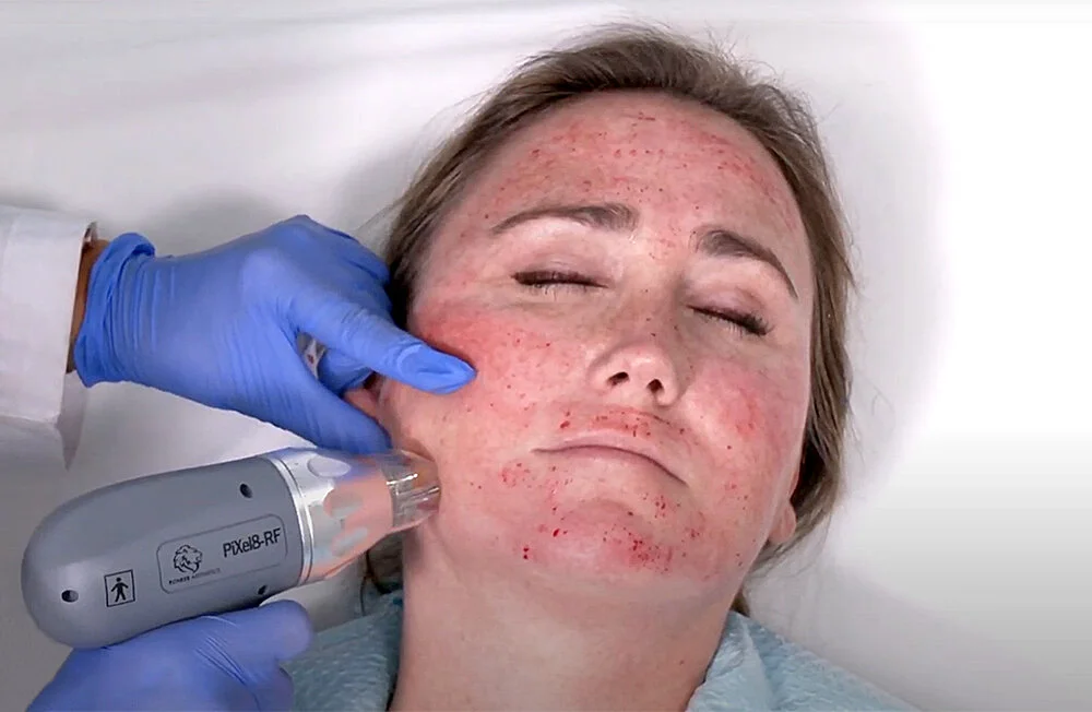 Peels and Microneedling — Musuma Healthcare & Medical Spa, PLLC