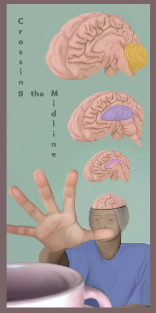 Why Is Crossing the Midline So Important for People With Parkinson’s ...
