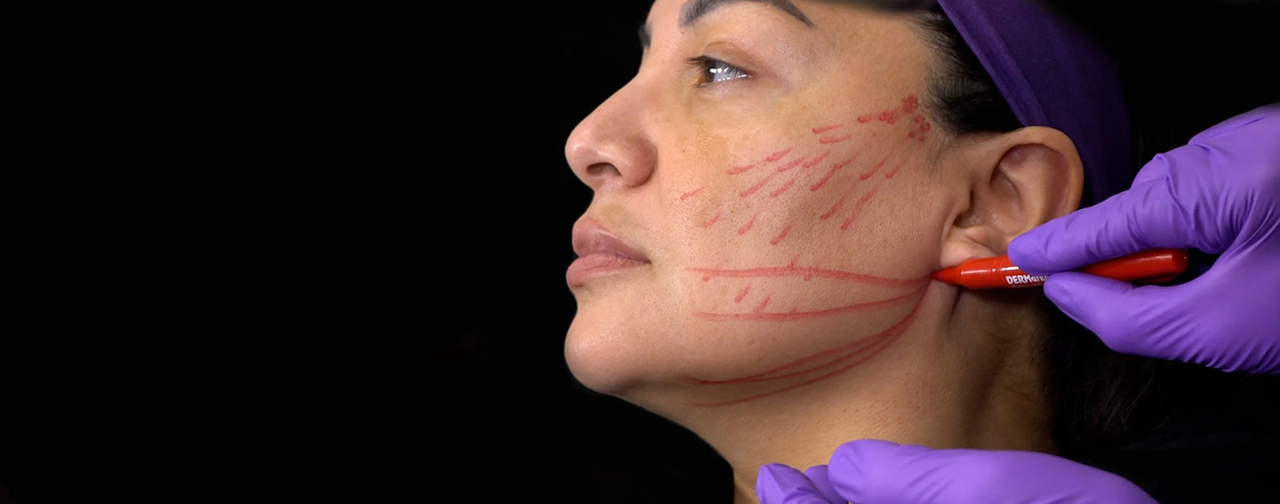 Threads Clinical Study — Dr. Kian