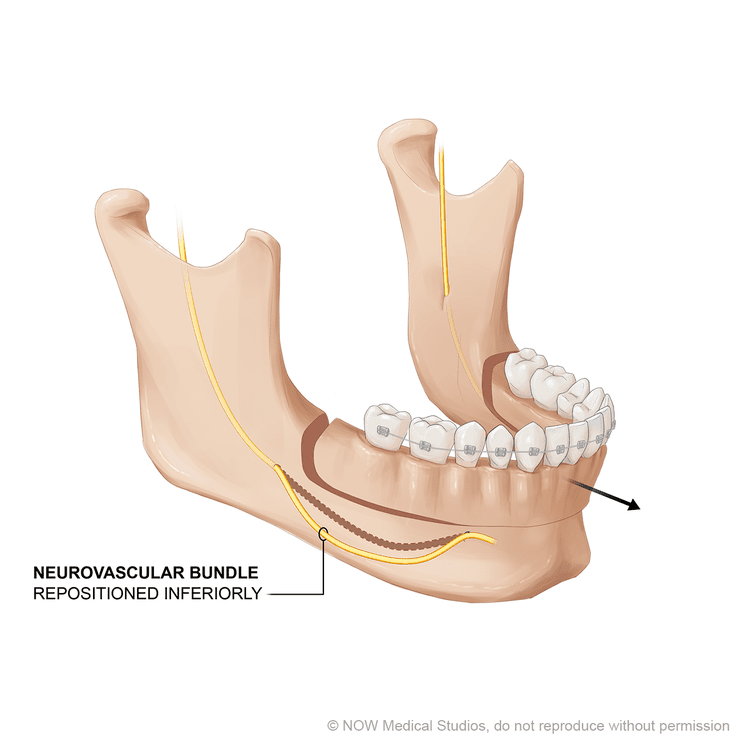 Medical illustration of orthodontic treatments for a dished in profile ...