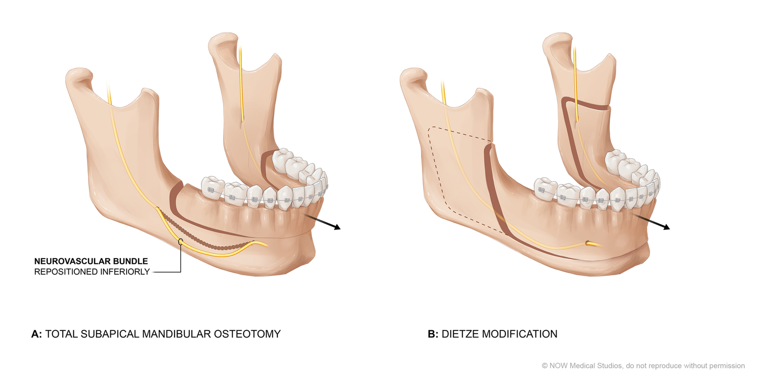 Medical illustration of orthodontic treatments for a dished in profile ...