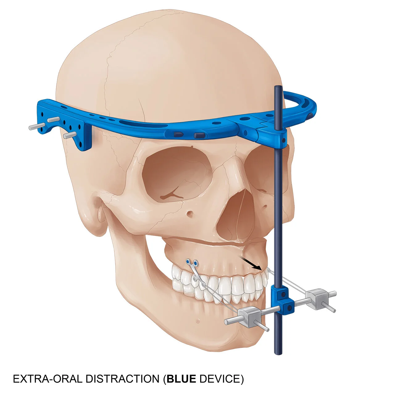 Medical illustration of orthodontic treatments for a dished in profile ...