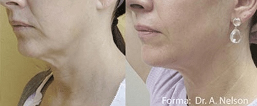 The Forma and Morpheus8 Facials Have Landed in Toronto — My Beauty Doctor