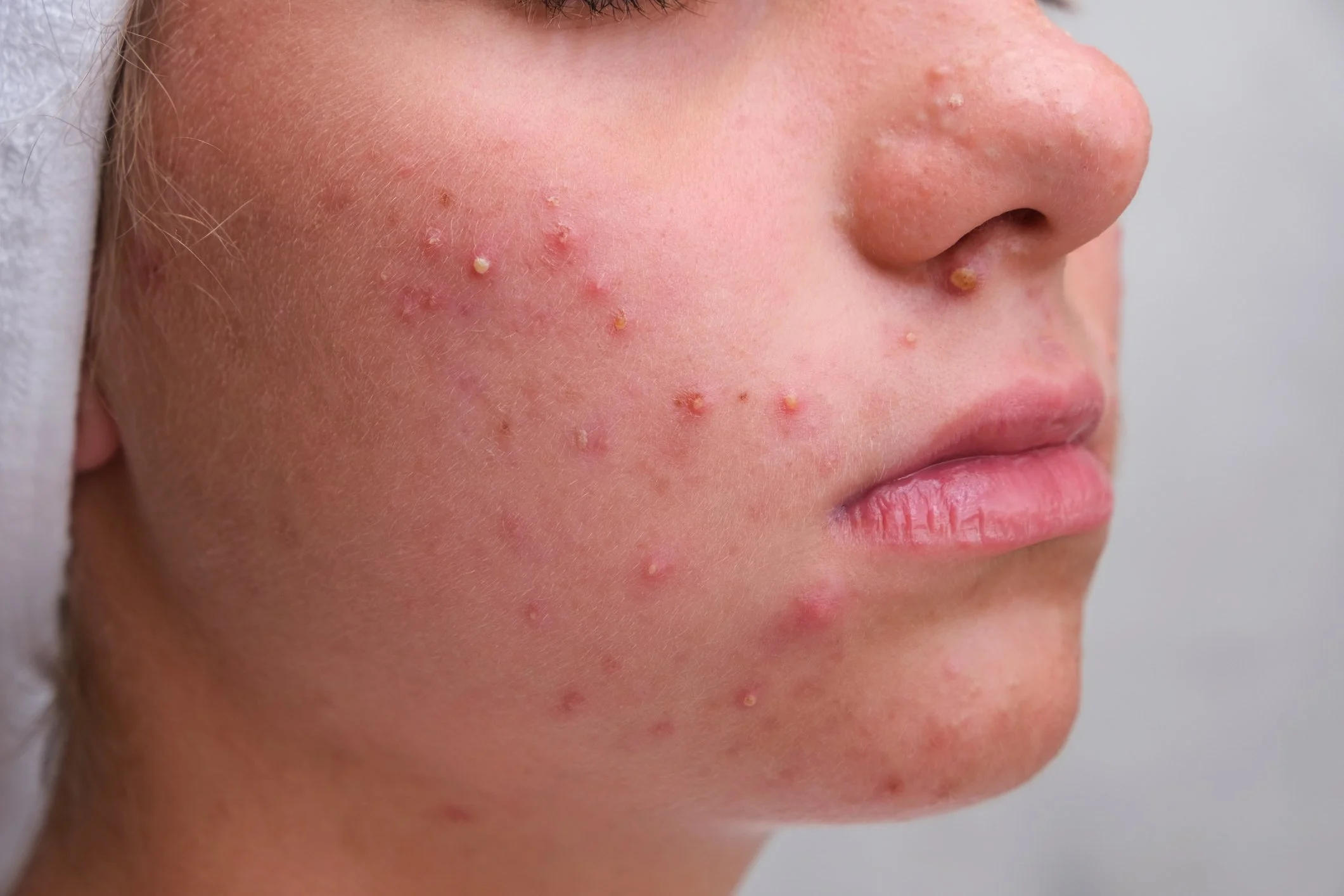 Acne – you don’t have to suffer — Dermatology Hawke's Bay