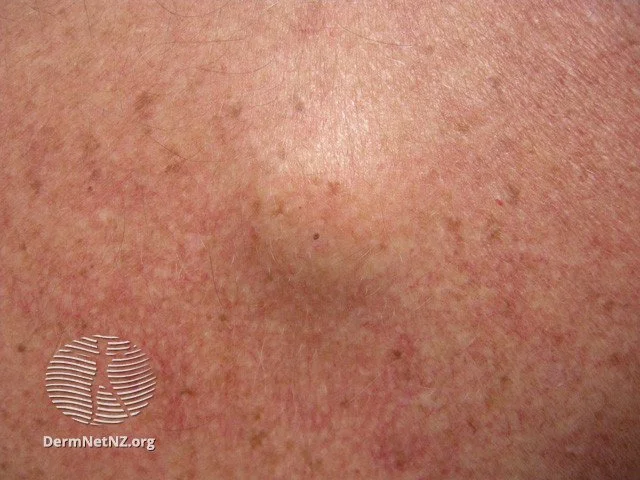 Abscess & Cyst | Schedule an Appointment Today — MiSkinCenter