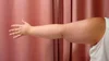 LE&RN: Identifying Fibrosis in Every Stage of Lymphedema — Karen Ashforth