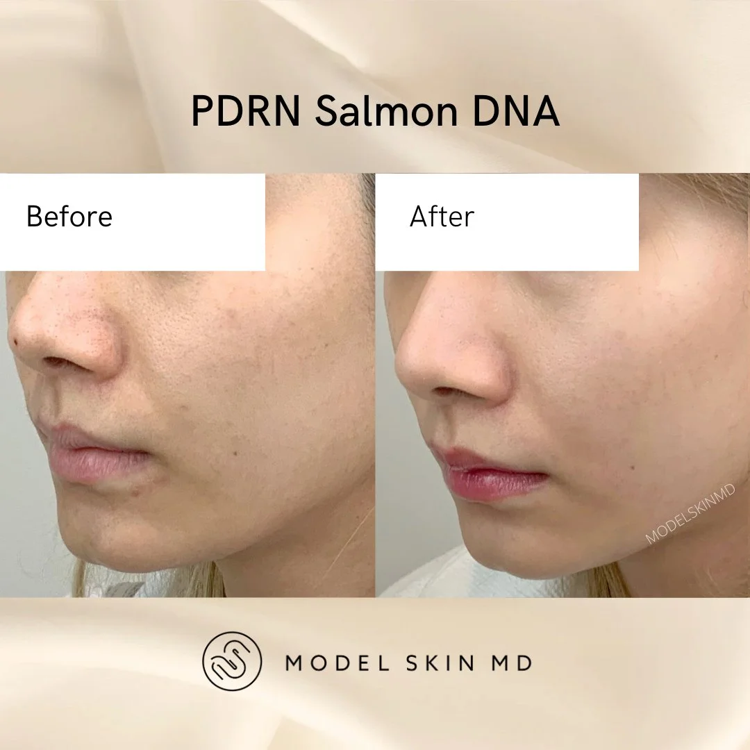 PDRN Salmon DNA Skin Booster Treatment - Vancouver's Aesthetic Cosmetic Laser Clinic — MODEL ...