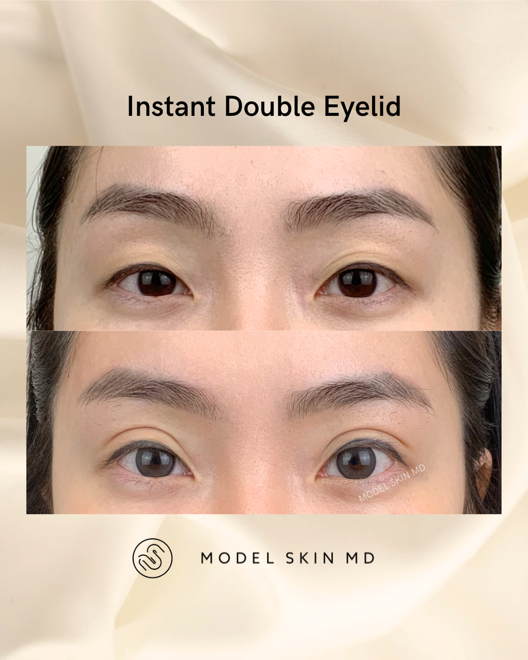 Asian Non-Incisional Double Eyelid Surgery - Vancouver's Aesthetic ...