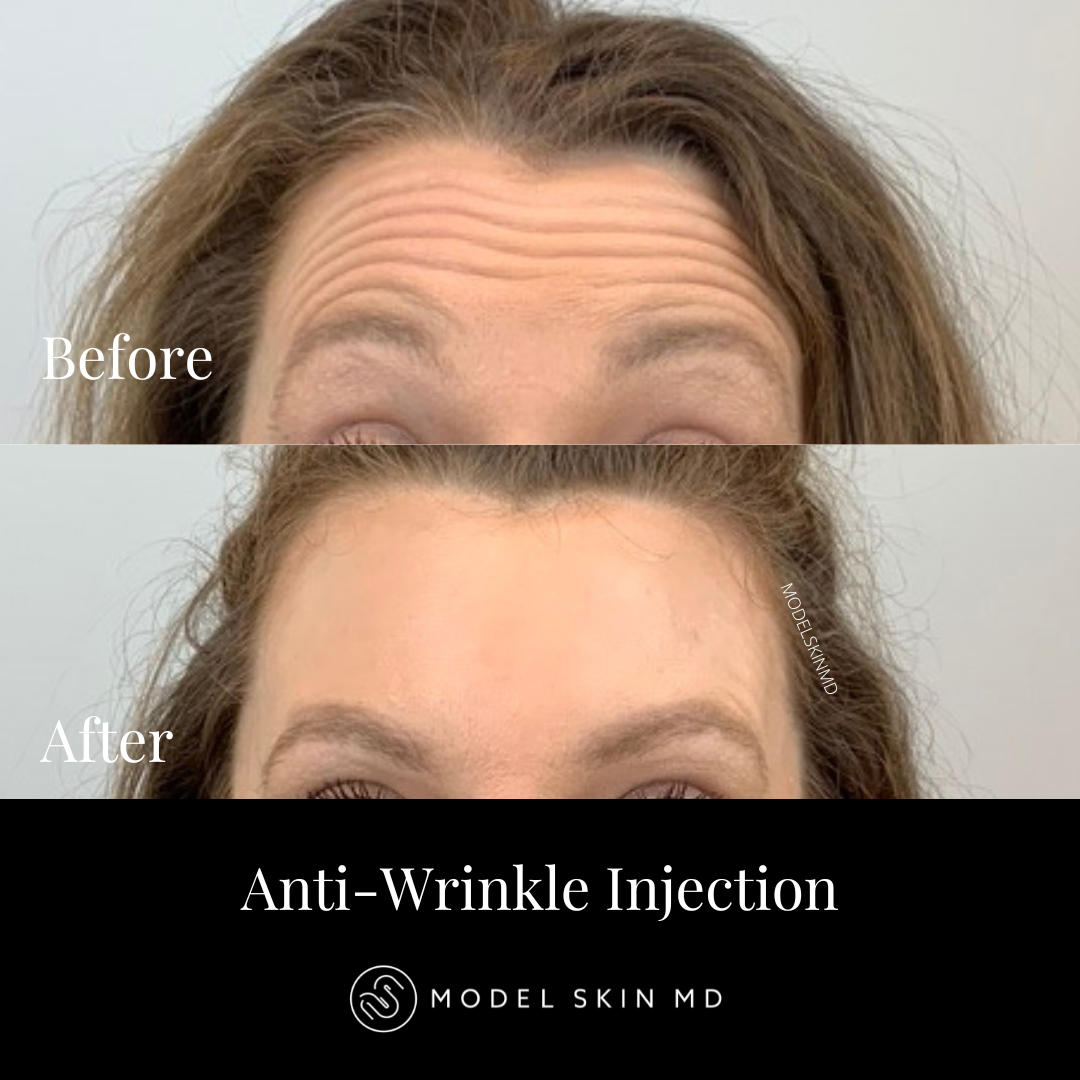 Neuromodulator (Botox) - Vancouver's Aesthetic Cosmetic Laser Clinic ...