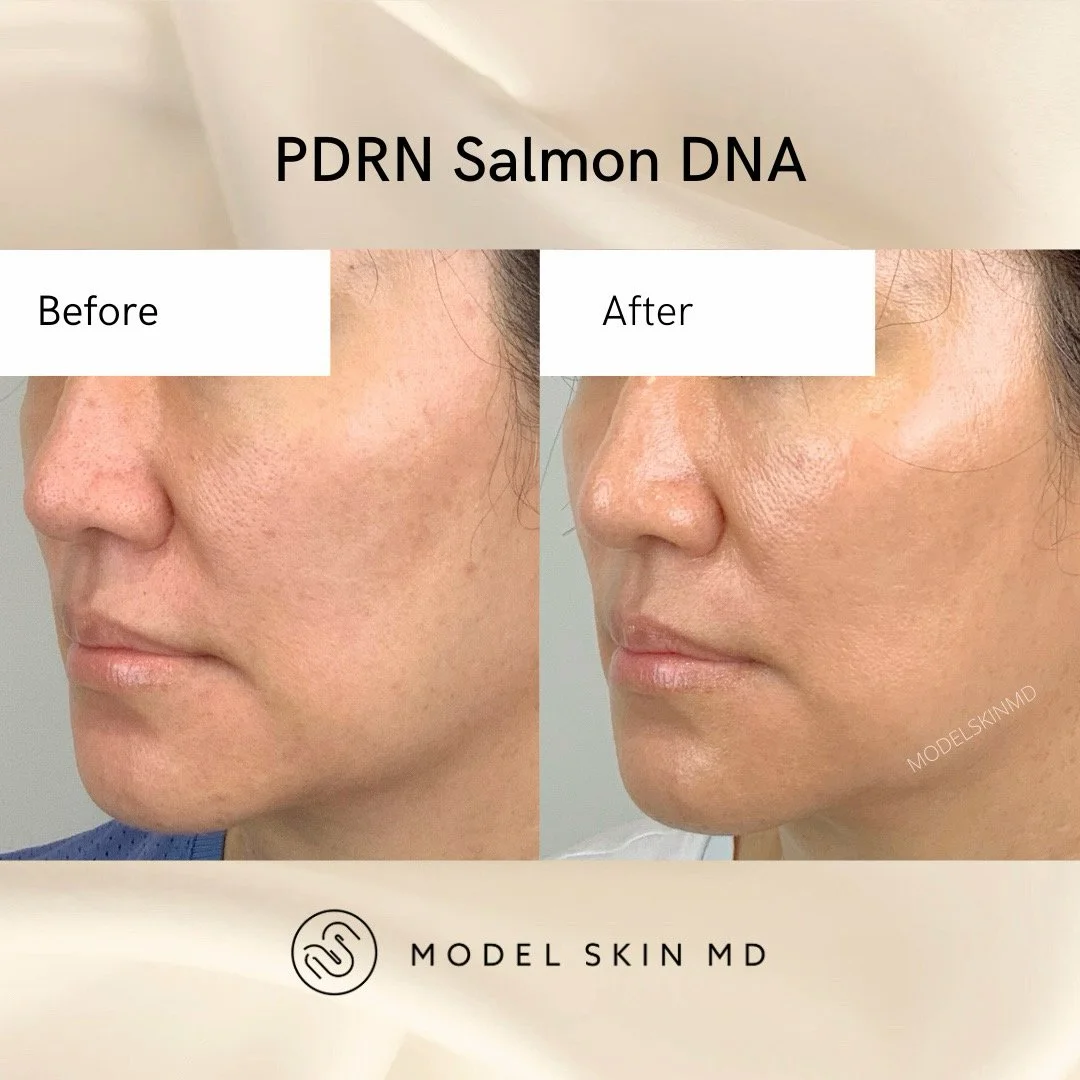 PDRN Salmon DNA Skin Booster Treatment - Vancouver's Aesthetic Cosmetic Laser Clinic — MODEL ...