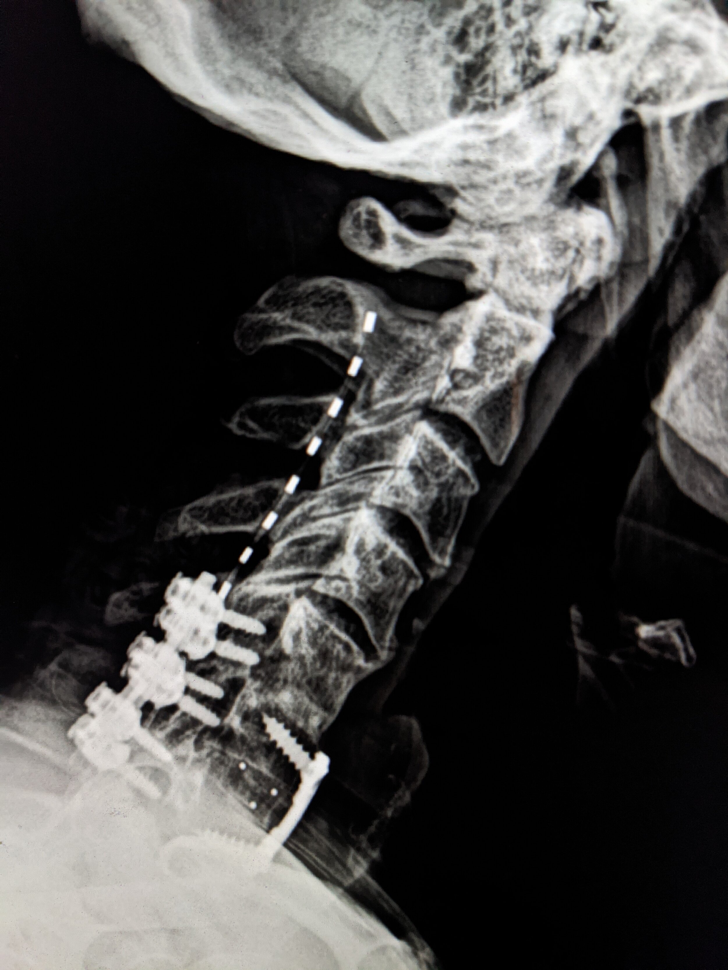 Dr. E Joe Kent III, MD - Interventional Pain Management