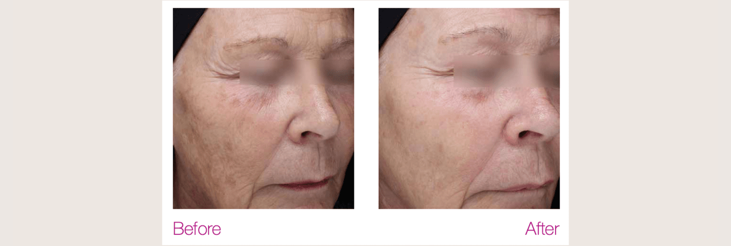 Intense Pulse Light — Harpeth Valley Dermatology - Live Site