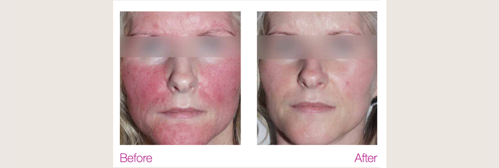 Intense Pulse Light — Harpeth Valley Dermatology - Live Site