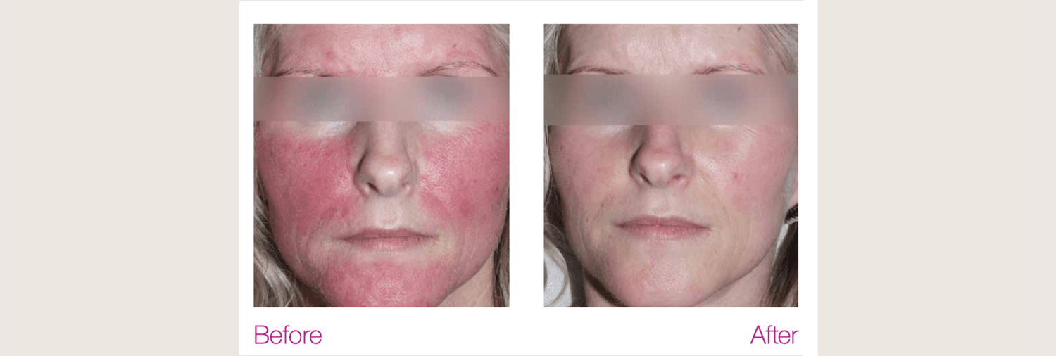 Intense Pulse Light — Harpeth Valley Dermatology - Live Site