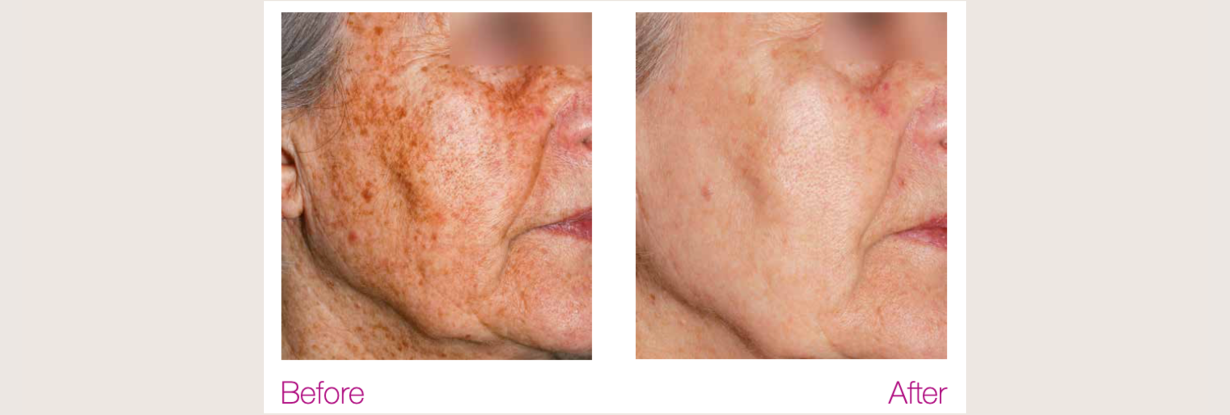 Intense Pulse Light — Harpeth Valley Dermatology - Live Site