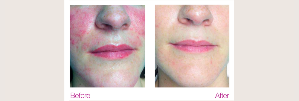 Intense Pulse Light — Harpeth Valley Dermatology - Live Site