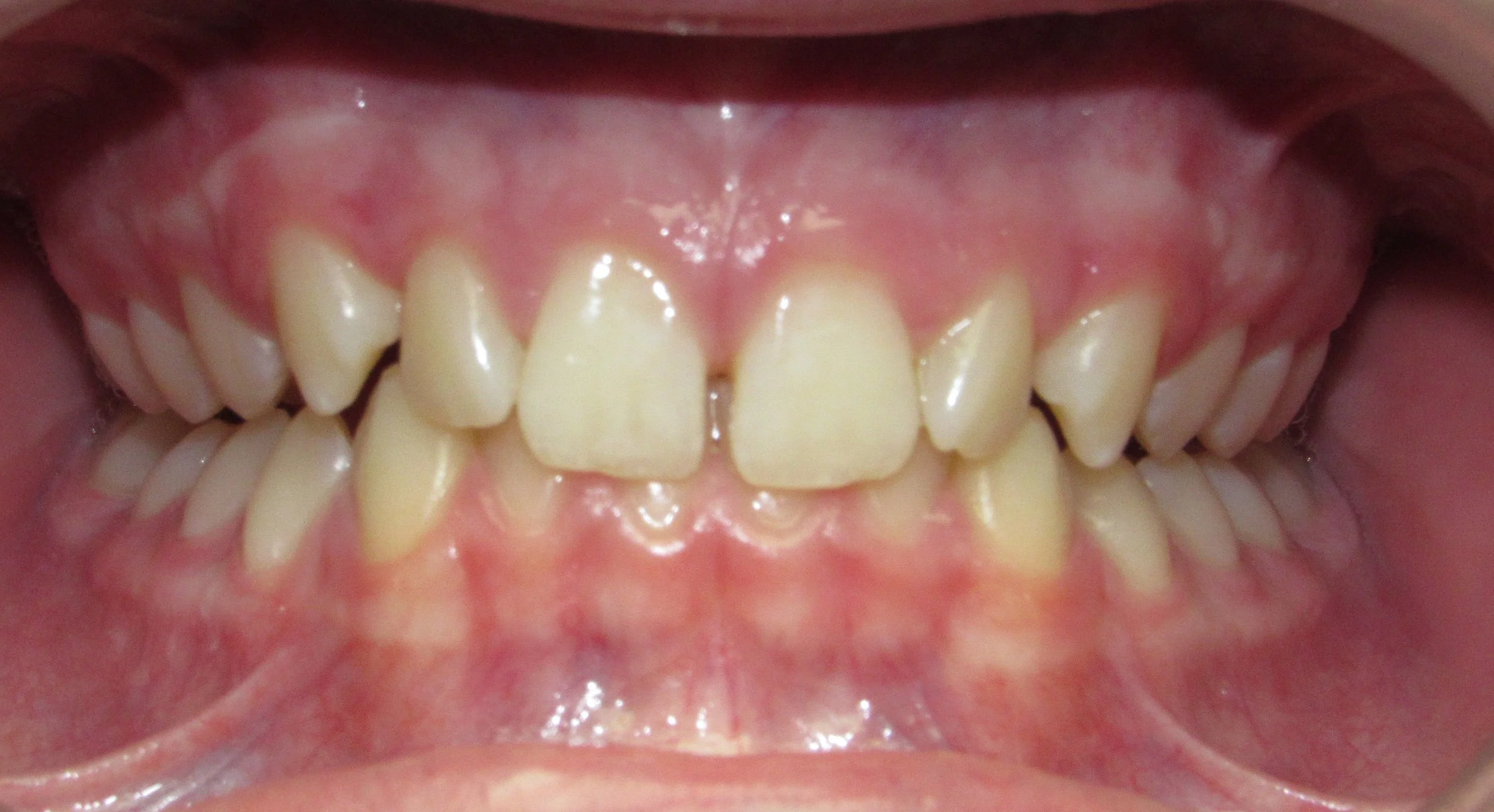 Common Bite Problems in Adults and Children: Malocclusions — Hillam ...