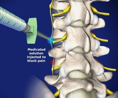 Lumbar Sympathetic Block — Pawleys island pain management