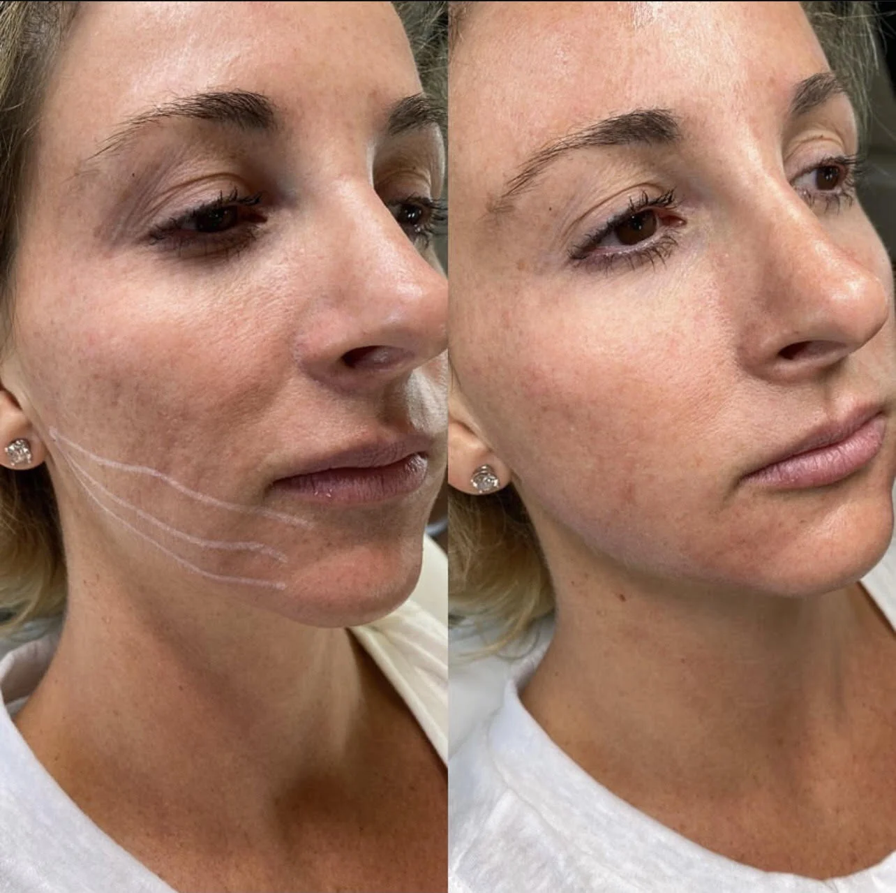 PDO Threads Near Me Non Surgical Face Lifting Body Lifting