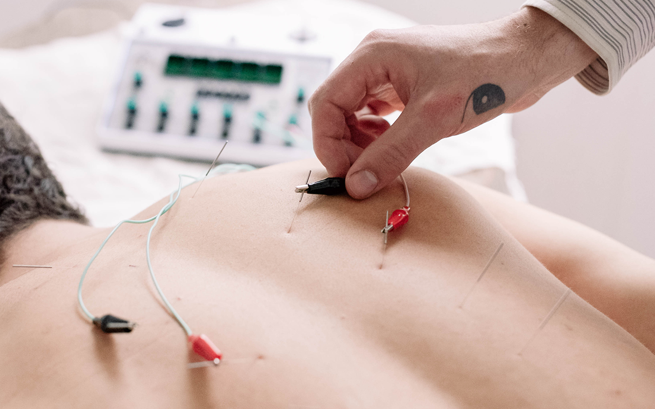Unlocking Exercise Enhancements: The Science Behind Acupuncture, Electro-Acupuncture, Cupping ...
