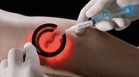 Veinlite Sclerotherapy — Kingston Vein Clinic