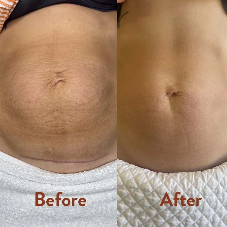 Non-Surgical Body and Skin Tightening | Derm Haus Brisbane