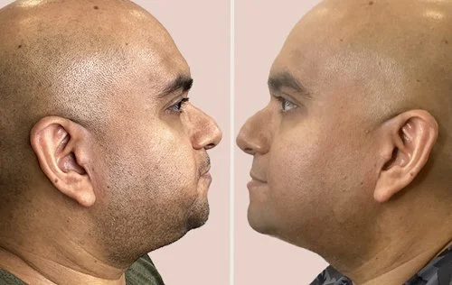 Fat Dissolving Chin Injections | Non-Surgical Double Chin Treatment