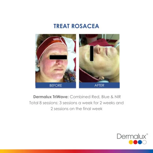 LED Light Therapy | Derm Haus Brisbane | Top Rated Clinic