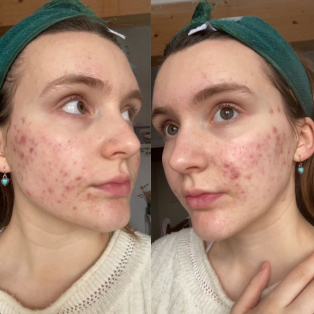 How to improve cystic acne using nutritional therapy — Swann | Nutrition