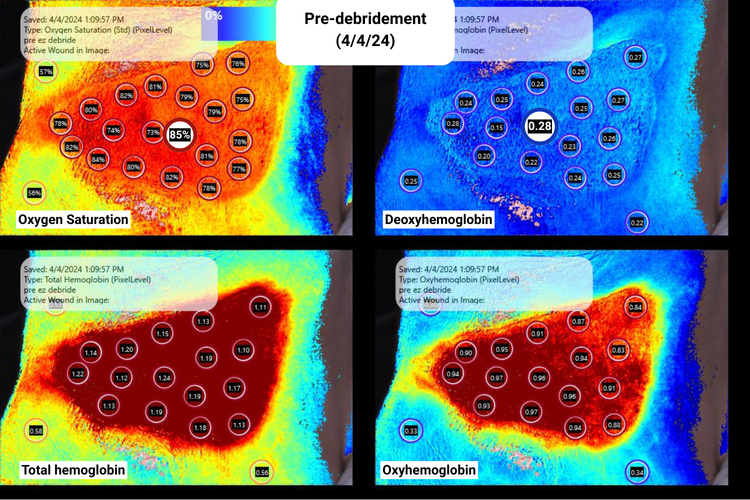 Wound Debridement and Skin Graft: A Case Study on Optimized Healing ...