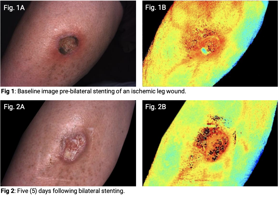 Vascular Screening and Intervention with SnapshotNIR — Kent Imaging