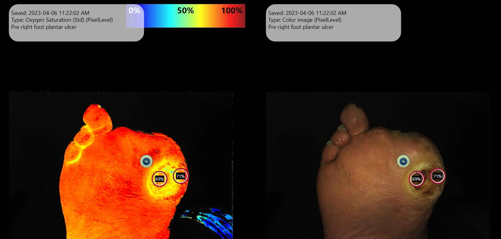 How do you know if your debridement intervention is working? NIRS ...