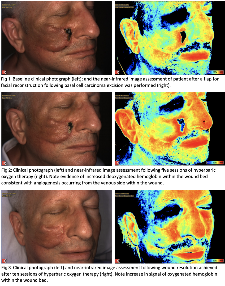 SnapshotNIR Tracks Compromised Facial Surgical Flap — Kent Imaging
