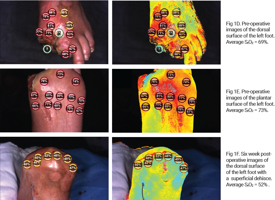 USING NIRS TO ASSESS OXYGENATION & PERFUSION IN THE PRE-OPERATIVE ...