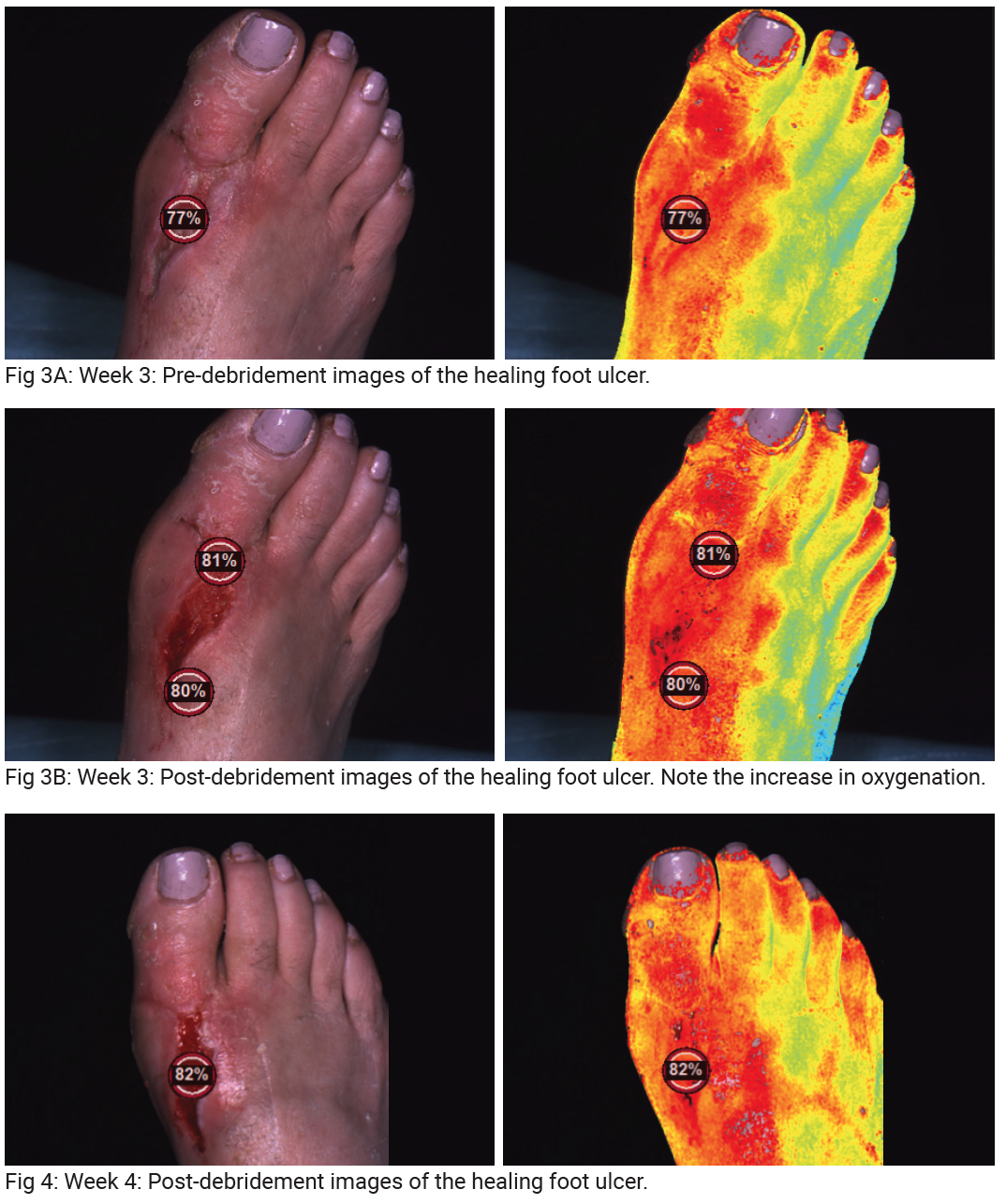 Using SnapshotNIR to Verify Debridement — Kent Imaging