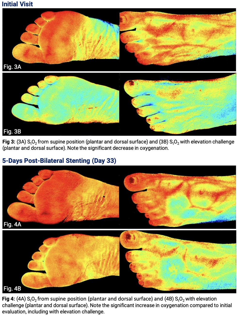 Vascular Screening and Intervention with SnapshotNIR — Kent Imaging