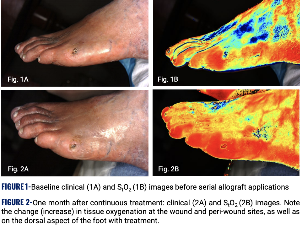 Non-healing Diabetic Foot Ulcer with SnapshotNIR — Kent Imaging