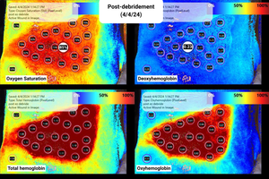 Wound Debridement and Skin Graft: A Case Study on Optimized Healing ...