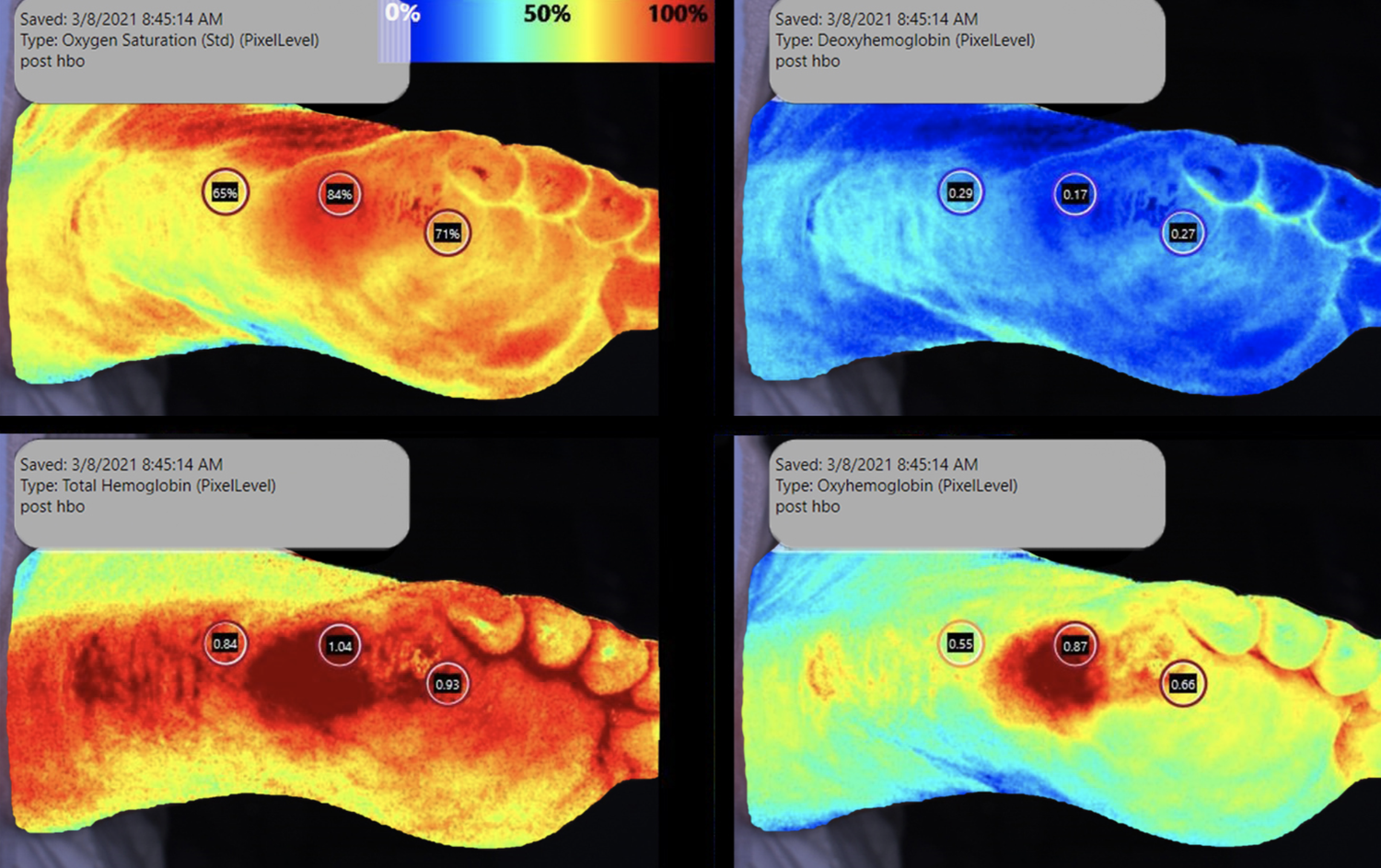 Early Detection and Prevention of Ulcers with SnapshotNIR — Kent Imaging