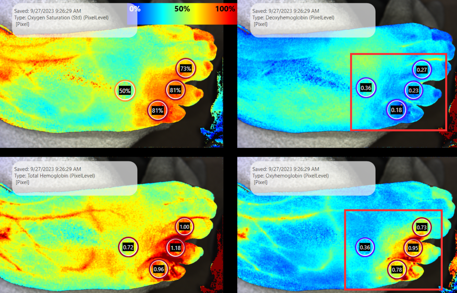 Using Hemoglobin View on SnapshotNIR In Clinical Practice — Kent Imaging