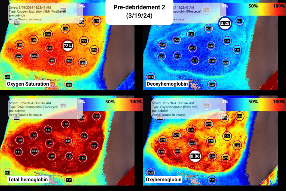 Wound Debridement and Skin Graft: A Case Study on Optimized Healing ...